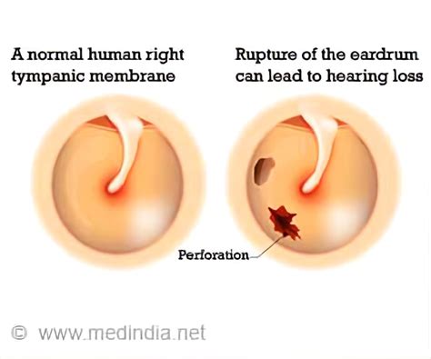 Tympanic Membrane Perforation Repair
