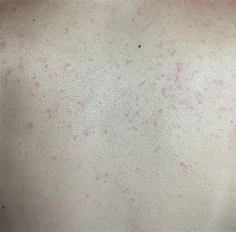Are These Hives Went To The Ocean Today And Had These All Over My Back