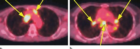 Metastatic Mediastinal Adenopathy In A 59 Year Old Woman With A History