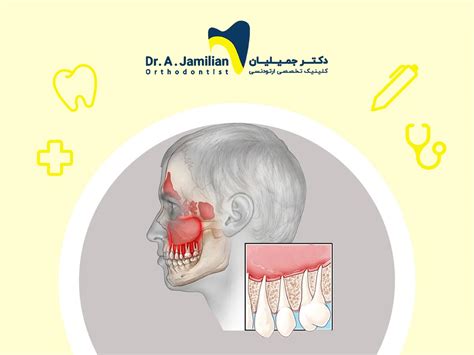 Sinus Opening Due To Tooth Extraction Dr Jamilian