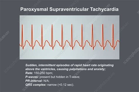 Supraventricular Tachycardia Heartbeat Rhythm Illustration Stock Image F041 7730 Science