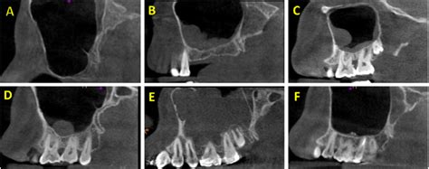 A Multiplanar Reformatted Sagittal Cone Beam Computed Tomography Images Download Scientific