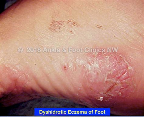 Dyshidrotic Eczema Feet