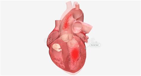 Cardiomyopathy Is A Disease Of The Heart Muscle That Causes The Stock