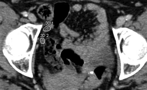 Normal Appendix In Adults Reproducibility Of Detection With Unenhanced