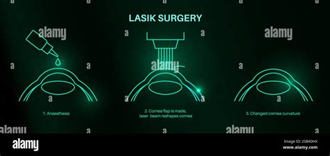 Illustration Of Lasik Laser Assisted In Situ Keratomileusis Also