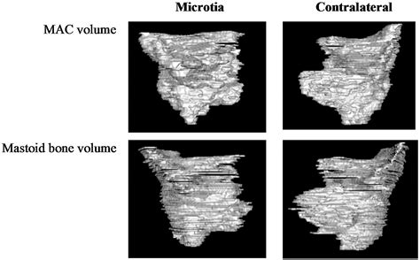Evaluation Of Mastoid Volume And Dimensions In Unilateral Microtia