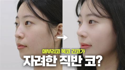 순수 우유에 자려한 직반코 한 스푼 코성형 브이로그 Youtube