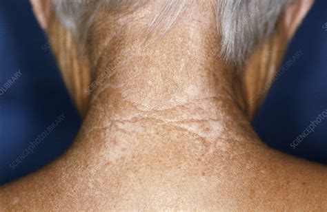 Scleroderma Stock Image M2600309 Science Photo Library