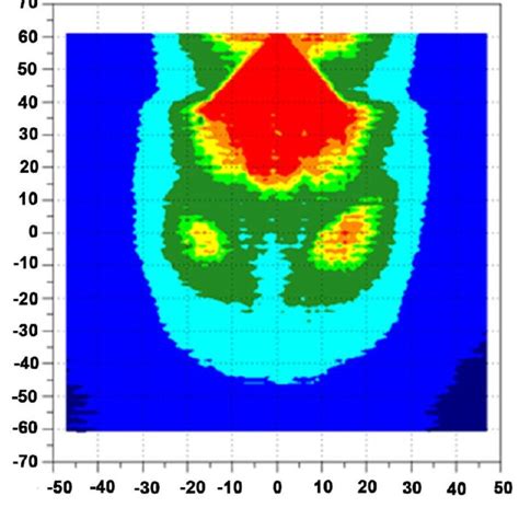 Right Side A Proton Beam B Wax Compensator C Nasal Plexiglas Download Scientific