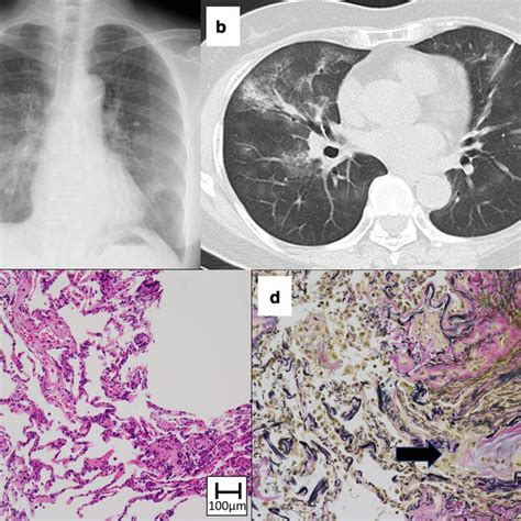 Chest X Ray Image Showing Bilateral Lung Infiltrates And Ground Glass