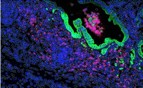 decoding cancer complexity via the largest multi omic spatial atlas