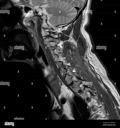 Sagittal View Of Magnetic Resonance Image Of Mri Of Cervical Spine