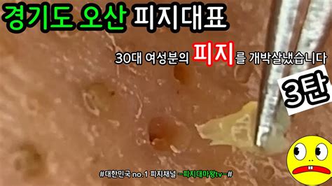 피지 직접 뽑아드렸습니다 피지제거 블랙헤드제거 피지뽑기 경기도를 통틀어 이분이 레전드가 될거 같은데 모두들 동의하시나요 대 여성분의 피지를 산산조각 박살냈습니다