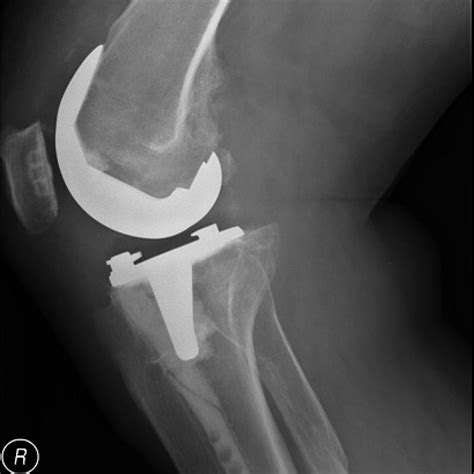 Computer Imaging In Knee Replacement Filipino Doctors