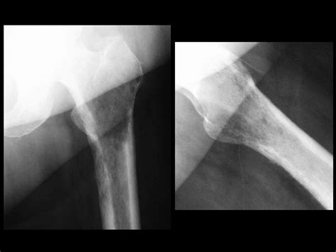Anterior Shoulder Dislocation Findings Inferomedial Subcoracoid Displacement Of