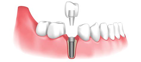 Do Dental Implant Has A Serial Number Dental News Network
