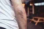 Track Marks A Sign Of Iv Drug Abuse Harmony Oaks
