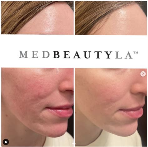 Resurfx Before And After Our Clinics Results