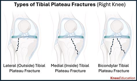 Tibial Plateau Fractures Knee Education