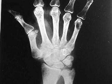 Calcium Pyrophosphate Deposition Disease CPPD Imaging And Diagnosis Practice Essentials