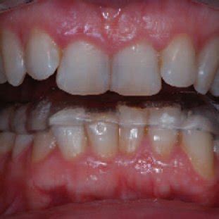 13 Permanent Tmj Splint MoaphaRisha