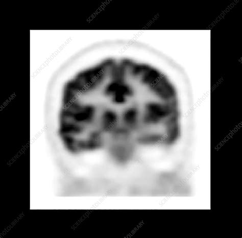 Mesial Temporal Sclerosis Mri Stock Image C039 4240 Science Photo Library