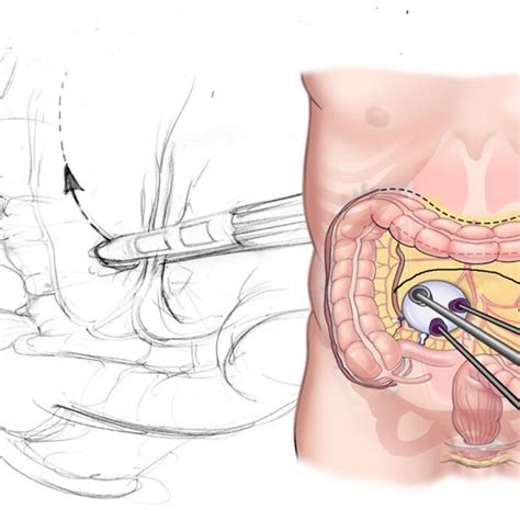 Dissection Is Proceeded To The Rectosigmoid Junction Download Scientific Diagram