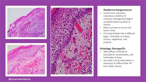 Jerad Gardner Md On Twitter How I Handle Nonspecific Ulcers On Biopsy To Rule Out Pyoderma