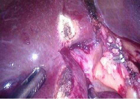Figure 1 From Laparoscopic Hepatectomy For Benign Hepatic Lesions Short And Long Term Outcomes