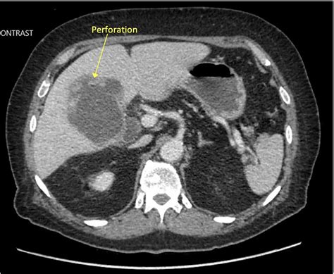 Perforated Gallbladder Rradiology
