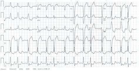 Lbbb Left Bundle Branch