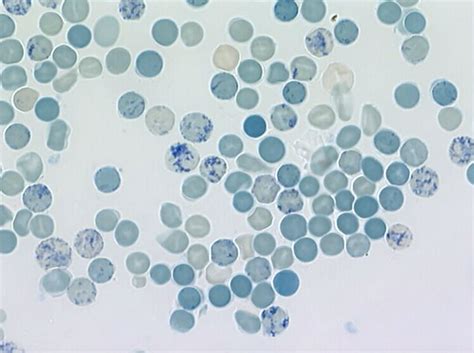 Reticulocyte Count Medicover