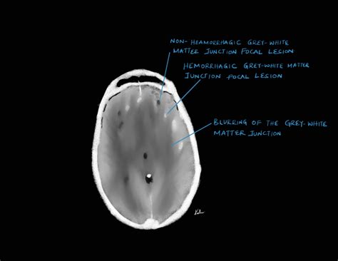 Head Injury Hyperexcision