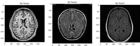 Figure 2 From Leveraging Lightweight Pretrained Model For Brain Tumour Detection Semantic Scholar