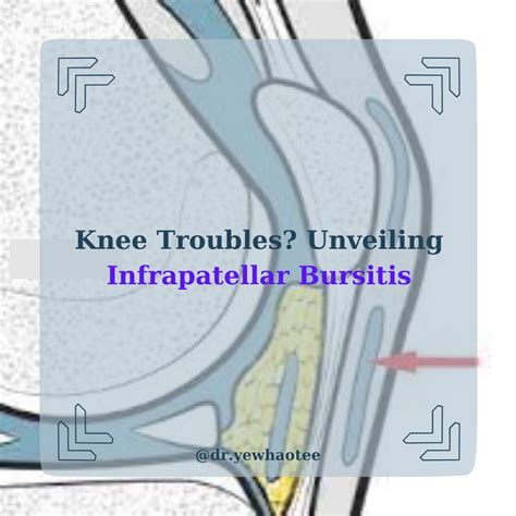 How To Prevent Infrapatellar Bursitis Dr Yew Hao Tee 鄭猷豪脊醫 Posted On The Topic Linkedin
