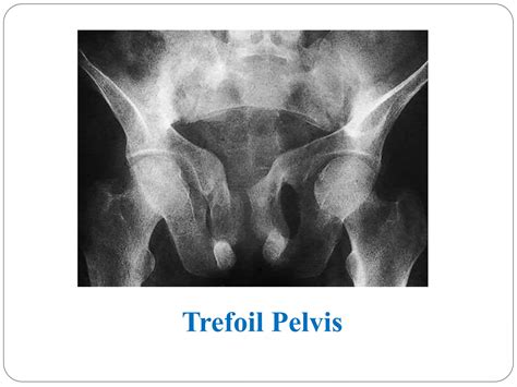 Rickets And Osteomalacia Pptx