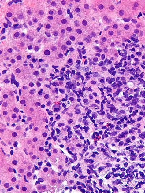 Autoimmune Hepatitis Wikipedia