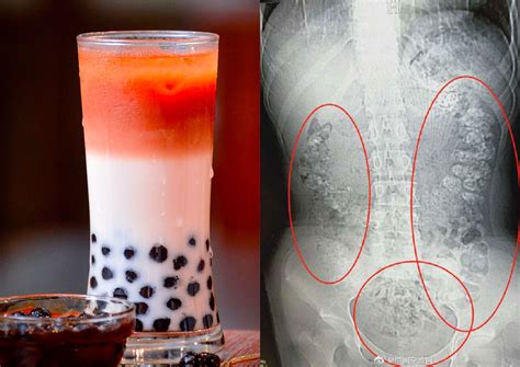 Chinese Girl Suffers Constipation For 5 Days The Cause Bubble Tea Pearls China News Asiaone