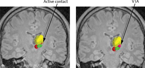 Computational Modeling And Tractography For Dbs Targeting Neupsy Key