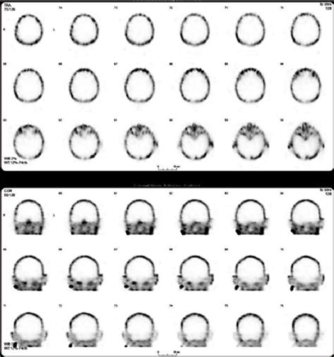 Brain Perfusion Spect Imaging With 99mtc Hmpao In A Patient With