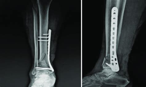 X Ray Of Distal Tibia Fractures Operated With Plating Download Scientific Diagram