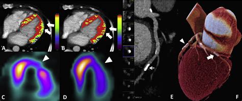 Dynamic Ct Myocardial Perfusion Imaging European Journal Of Radiology
