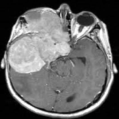 Brain Tumor Detector Object Detection Dataset And Pre Trained Model By Brain Tumor Detection