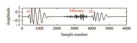 Visual Representation Of A Clean Pathological Signal Late Systolic