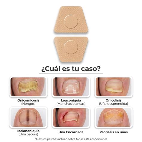 Parches Natural Correctores Uñas Encarnadas Hongos Pie 10und