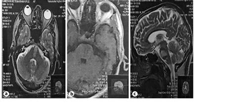 A Axial T2 Brain Mri Showing A Wedge Shaped Segmental Hyperintense