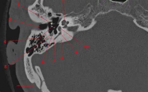 CT Scan Of The Temporal Bone W Radiology