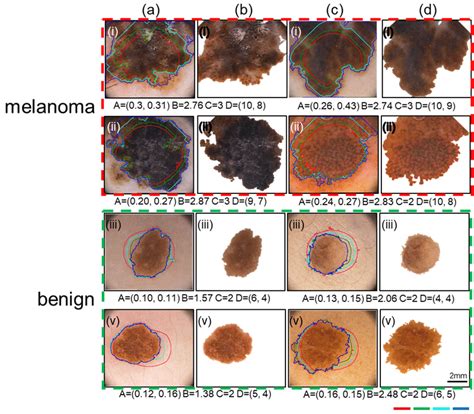The Segmentation Stage Identifies The Lesion From The Background Using