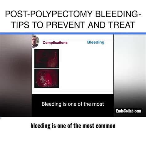 Klaus Mönkemüller On Linkedin Post Polypectomy Bleeding Tips To Prevent And Treat